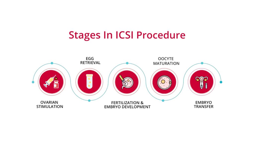 Intracytoplasmic Sperm Injection (ICSI) | Australian Concept